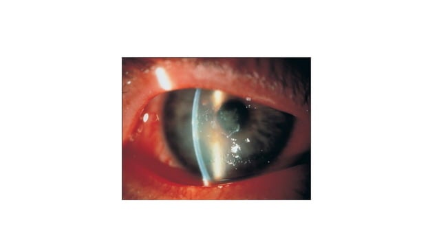 DISEASES OF THE CORNEA PH internal of the eye(1).pptx | Free Download