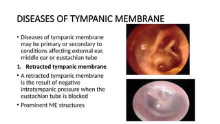 DISEASES OF THE EXTEhhhhhhhRNAL EAR-1.pptx
