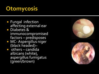 Diseases of the external ear | PPTX