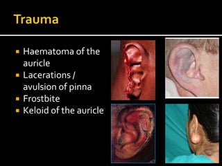 Diseases of the external ear | PPTX