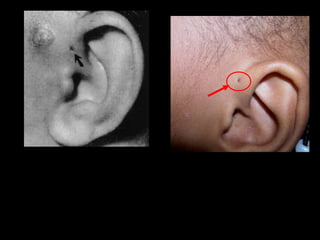 Diseases of the external ear | PPT