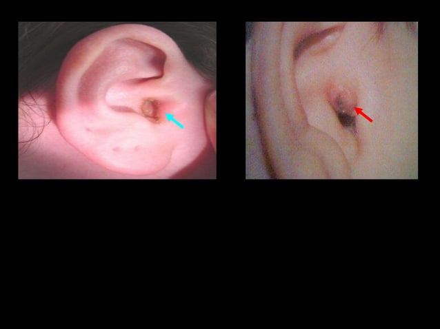 Diseases of the External Ear.ppt