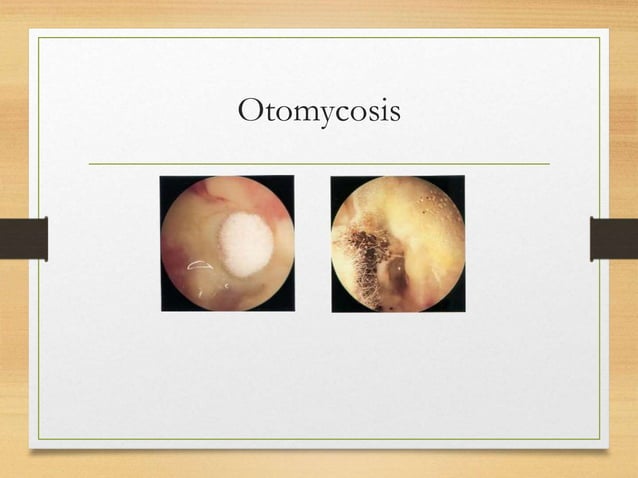 Diseases of the external ear and anatomy of the ear | PPT