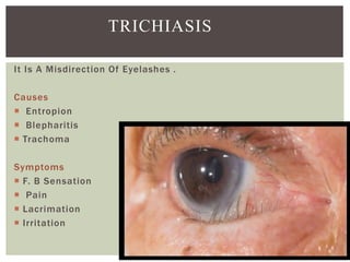 DISEASES OF THE EYELIDS.pptx
