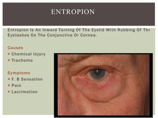 DISEASES OF THE EYELIDS.pptx