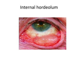 DISEASES OF THE EYE LIDS -JKUAT(1).pptx