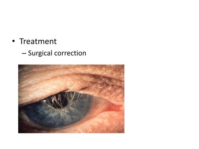 DISEASES OF THE EYE LIDS -JKUAT(1).pptx | Ear, Nose and Throat ...
