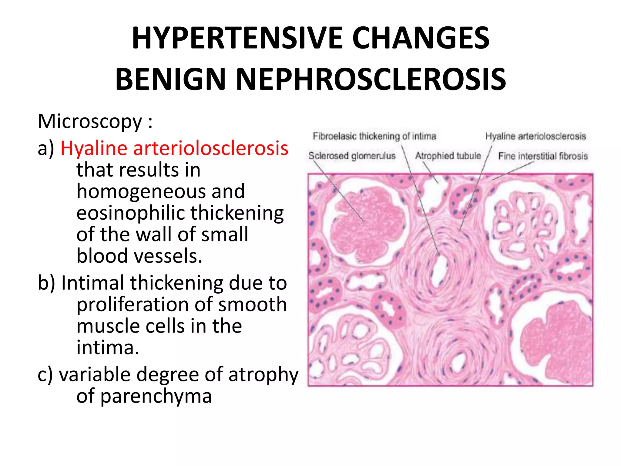 Diseases of the kidney | PPTX