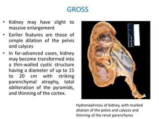 Hydronephrosis Gross
