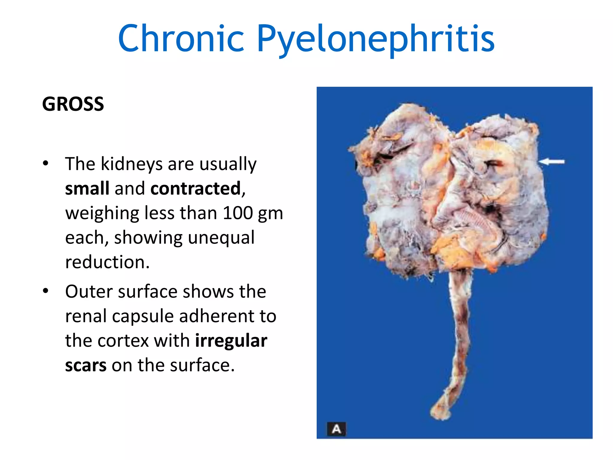 Diseases of the kidney | PPTX