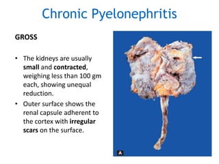 Diseases of the kidney | PPTX