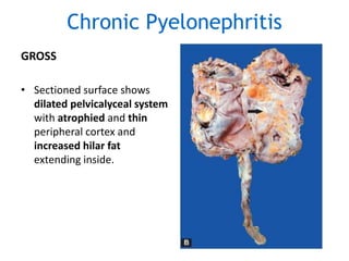 Diseases of the kidney | PPTX