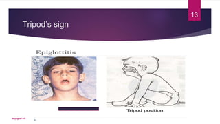 Diseases of the larynx | PPTX