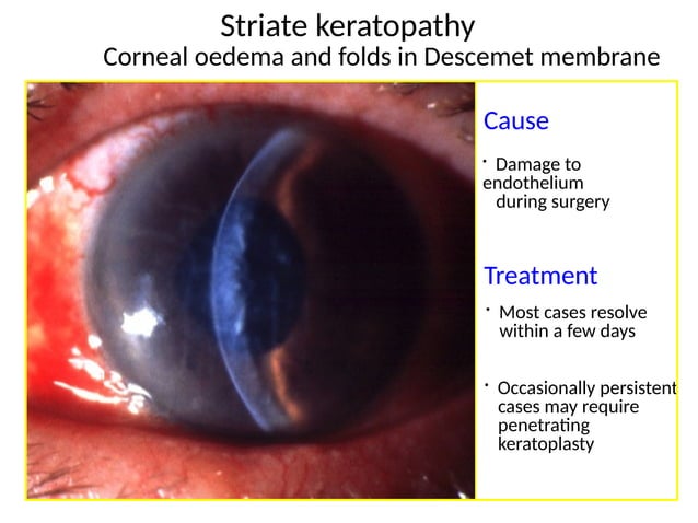 DISEASES OF THE LENS IN CLINICAL EXAMINATION | PPTX