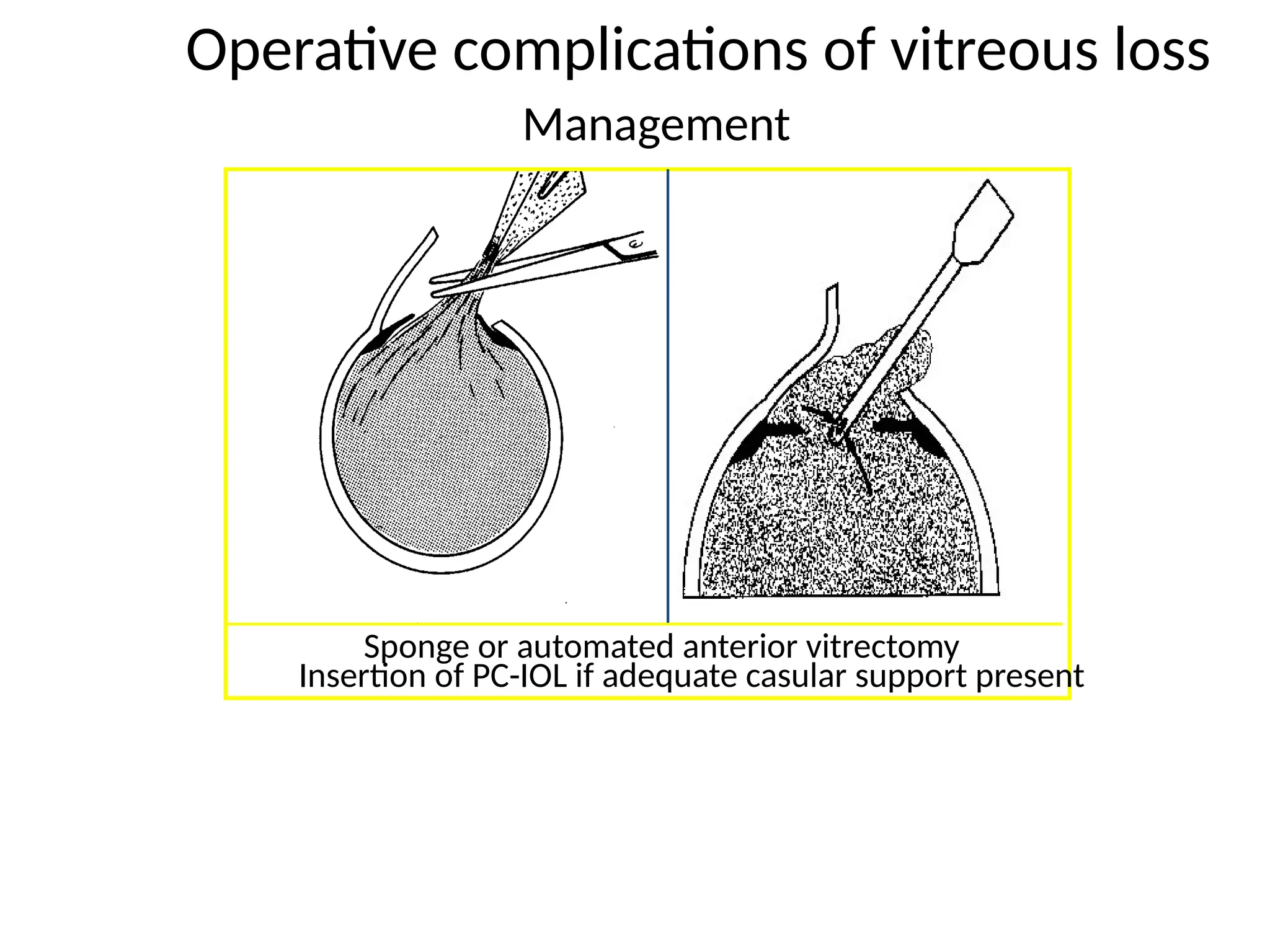 DISEASES OF THE LENS in preseptal and orbital cellulitis | PPTX
