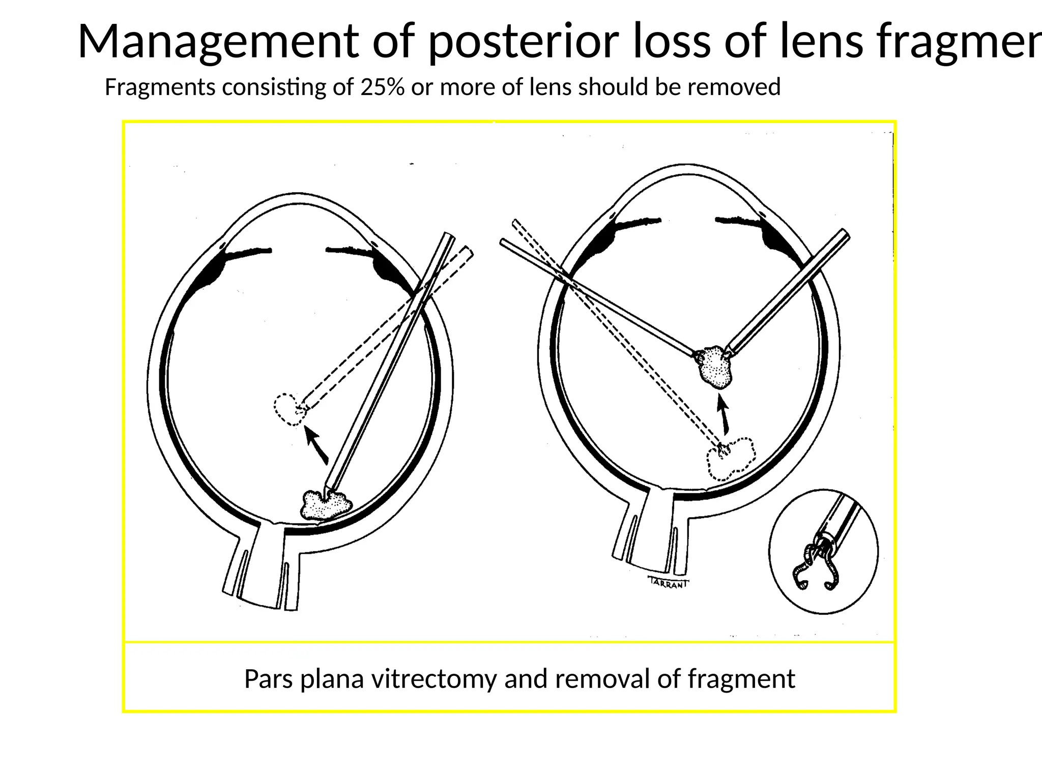 DISEASES OF THE LENS in preseptal and orbital cellulitis | PPTX