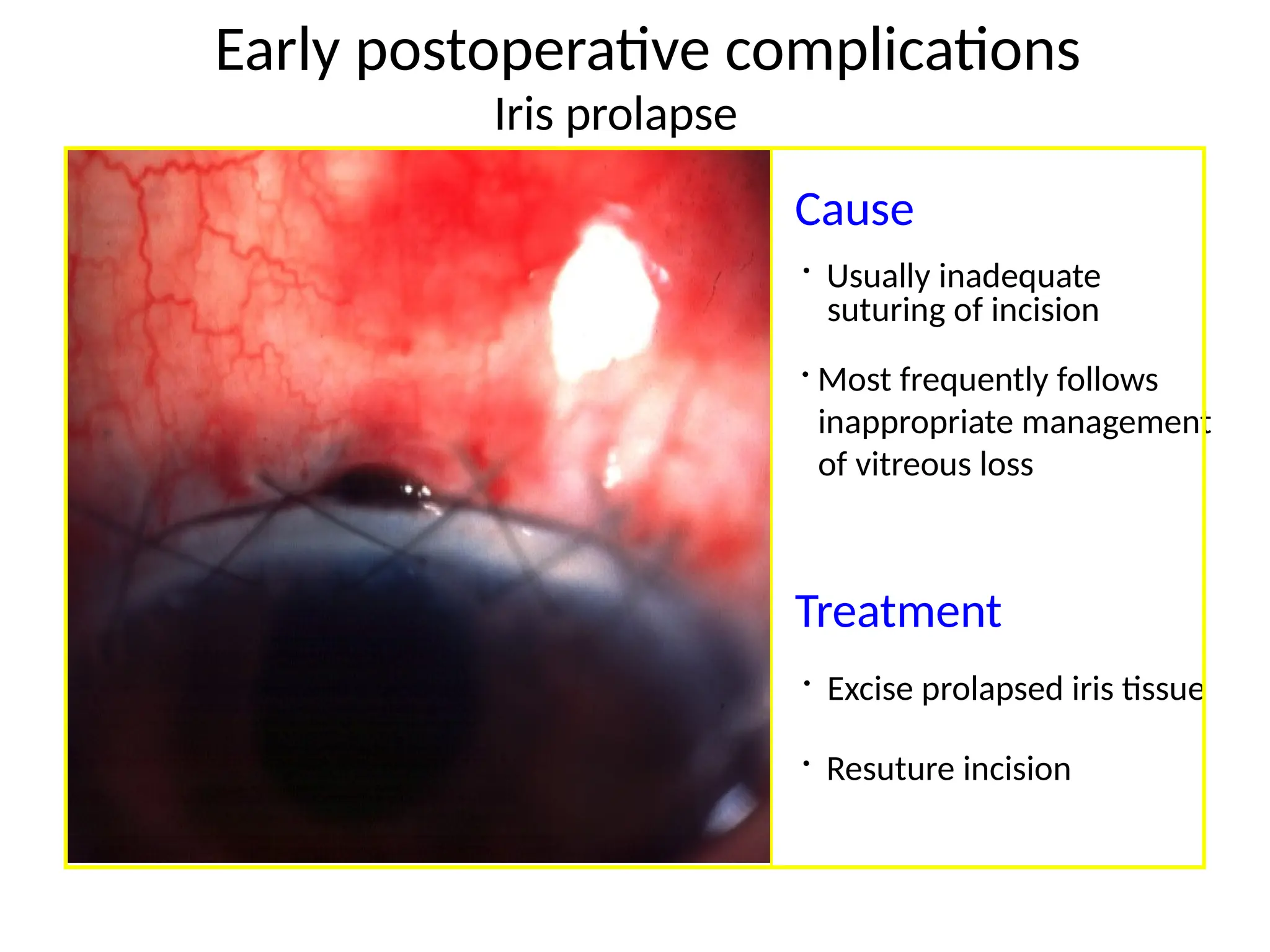 DISEASES OF THE LENS in preseptal and orbital cellulitis | PPTX