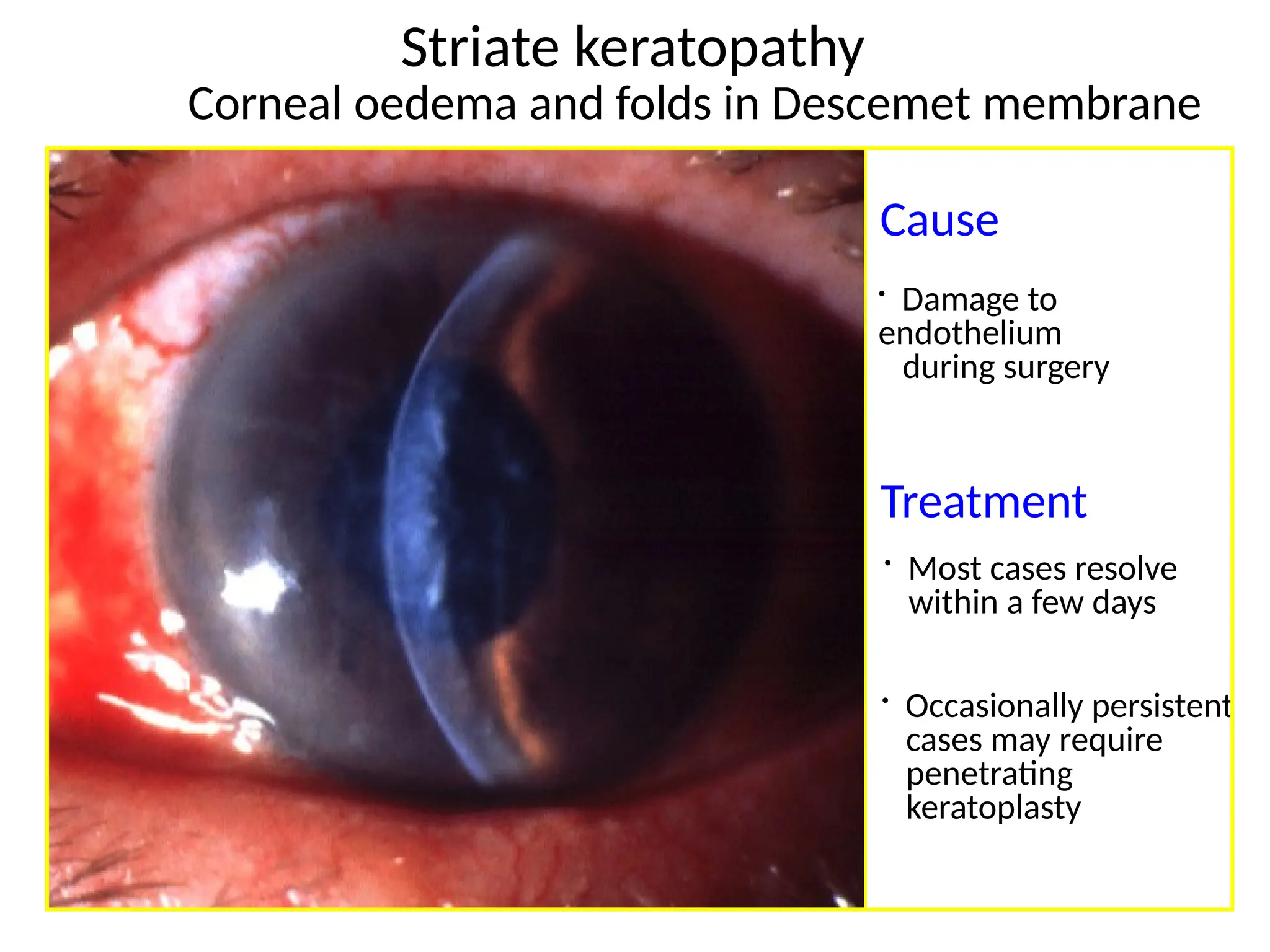 DISEASES OF THE LENS in preseptal and orbital cellulitis | PPTX