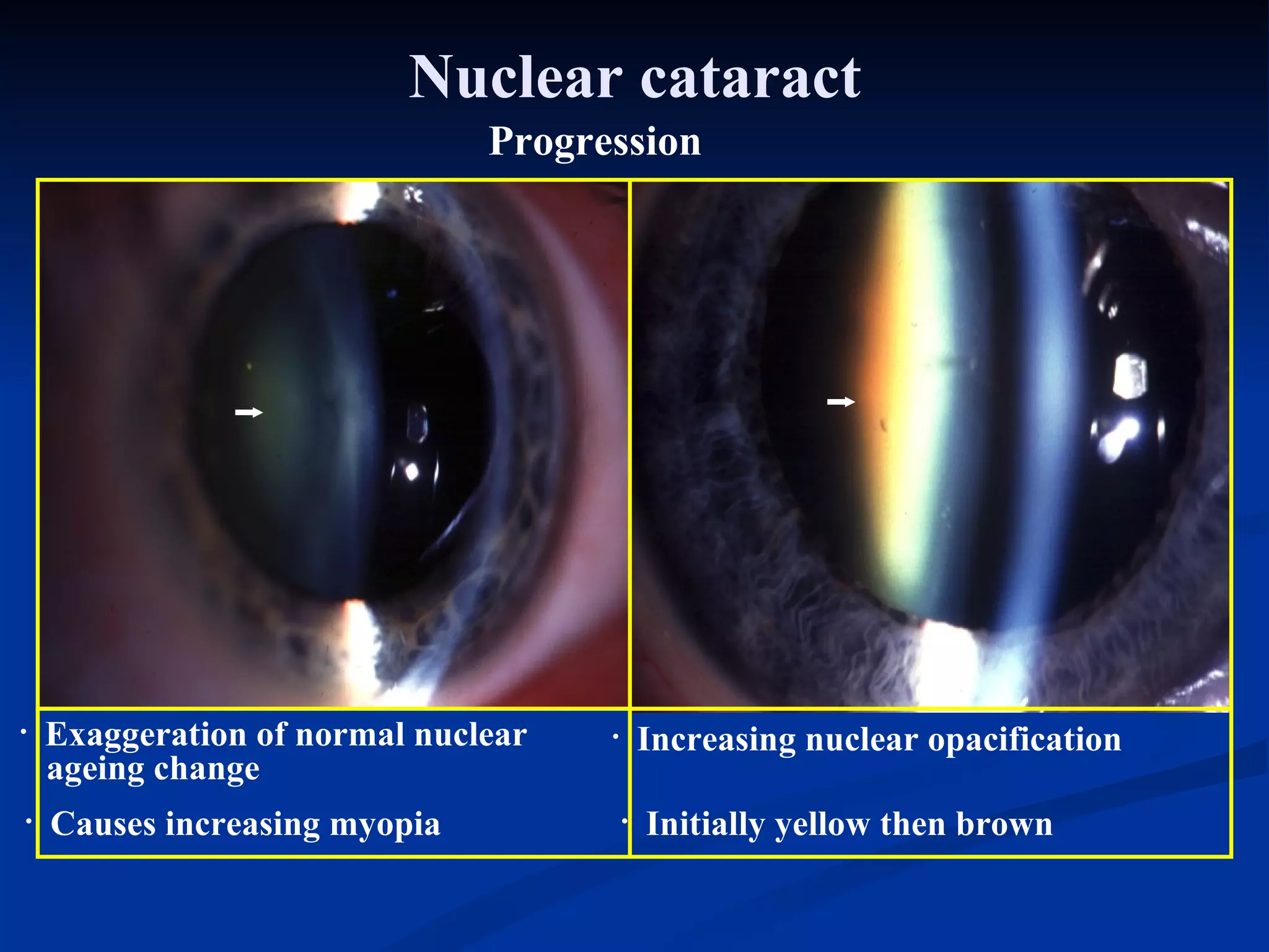 ophthalmology.Diseases of the lens.(dr.baxtyar) | PPT
