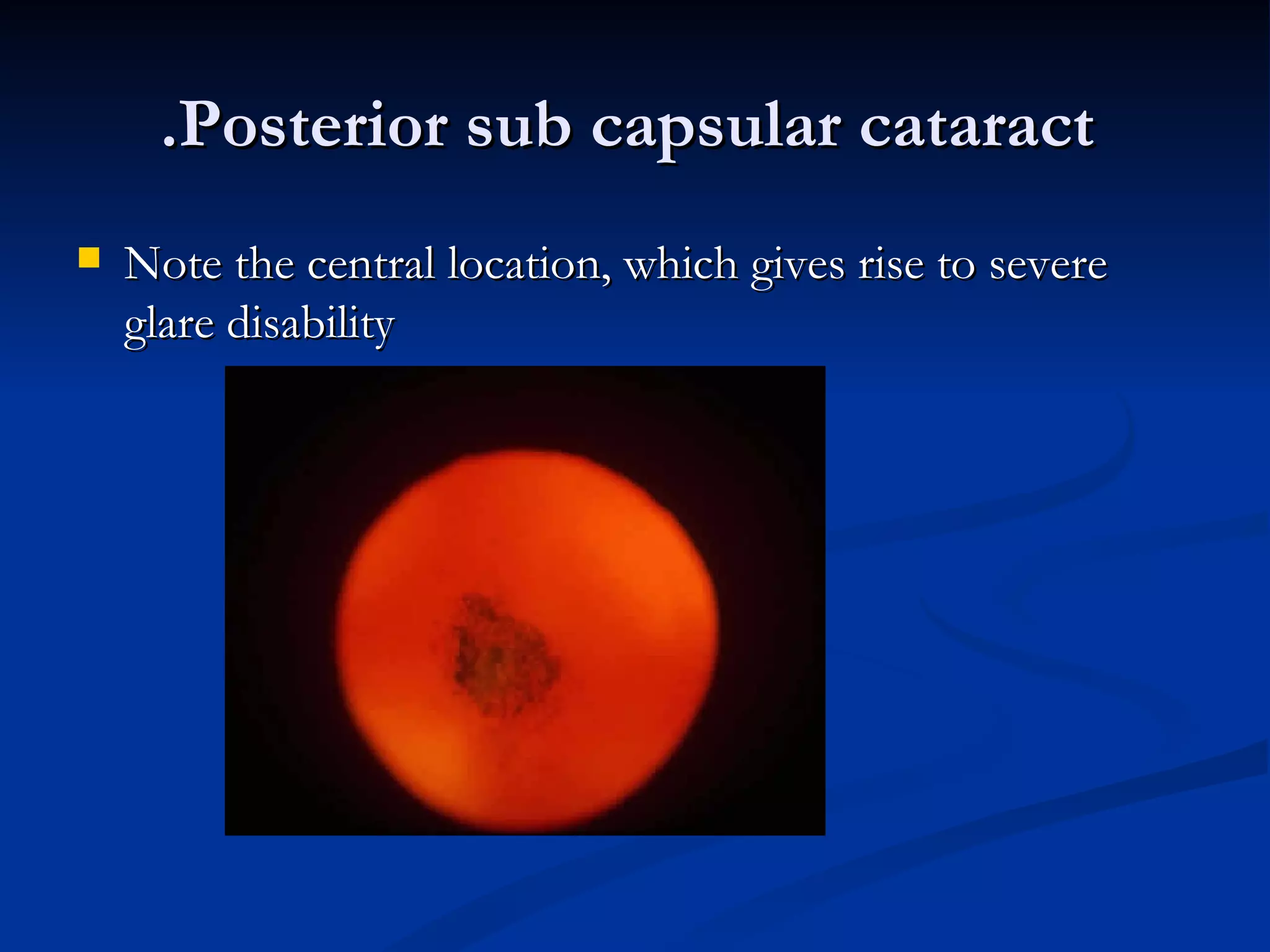 ophthalmology.Diseases of the lens.(dr.baxtyar) | PPT