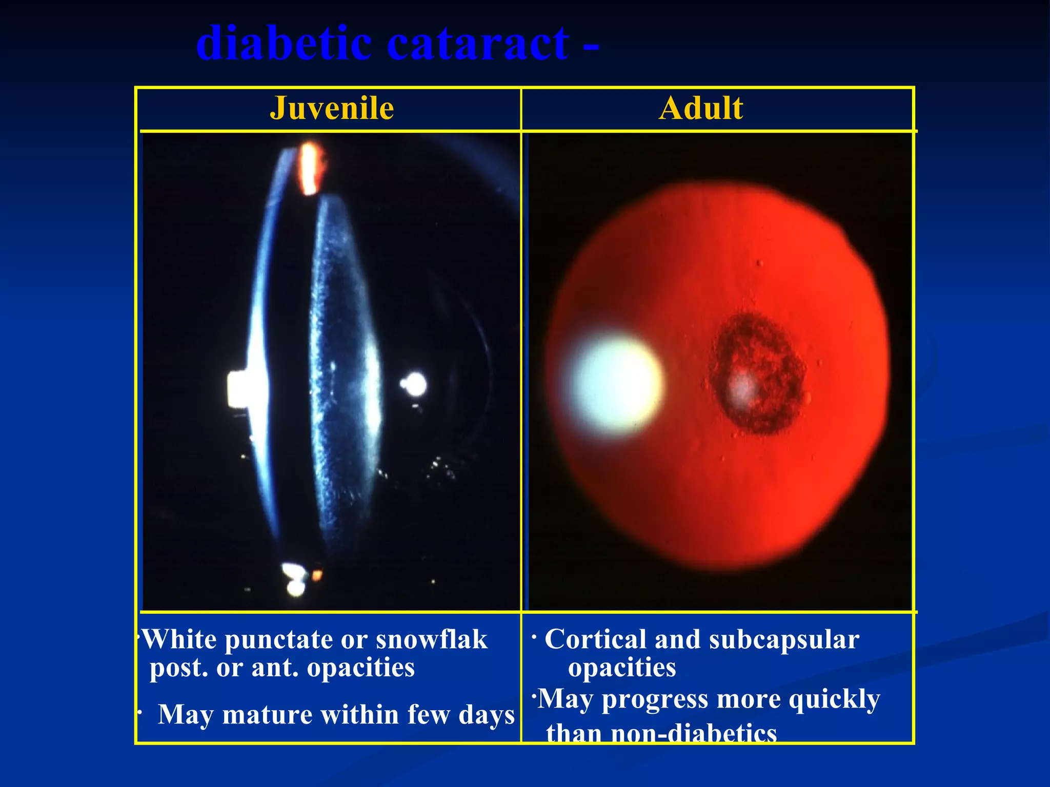 ophthalmology.Diseases of the lens.(dr.baxtyar) | PPT