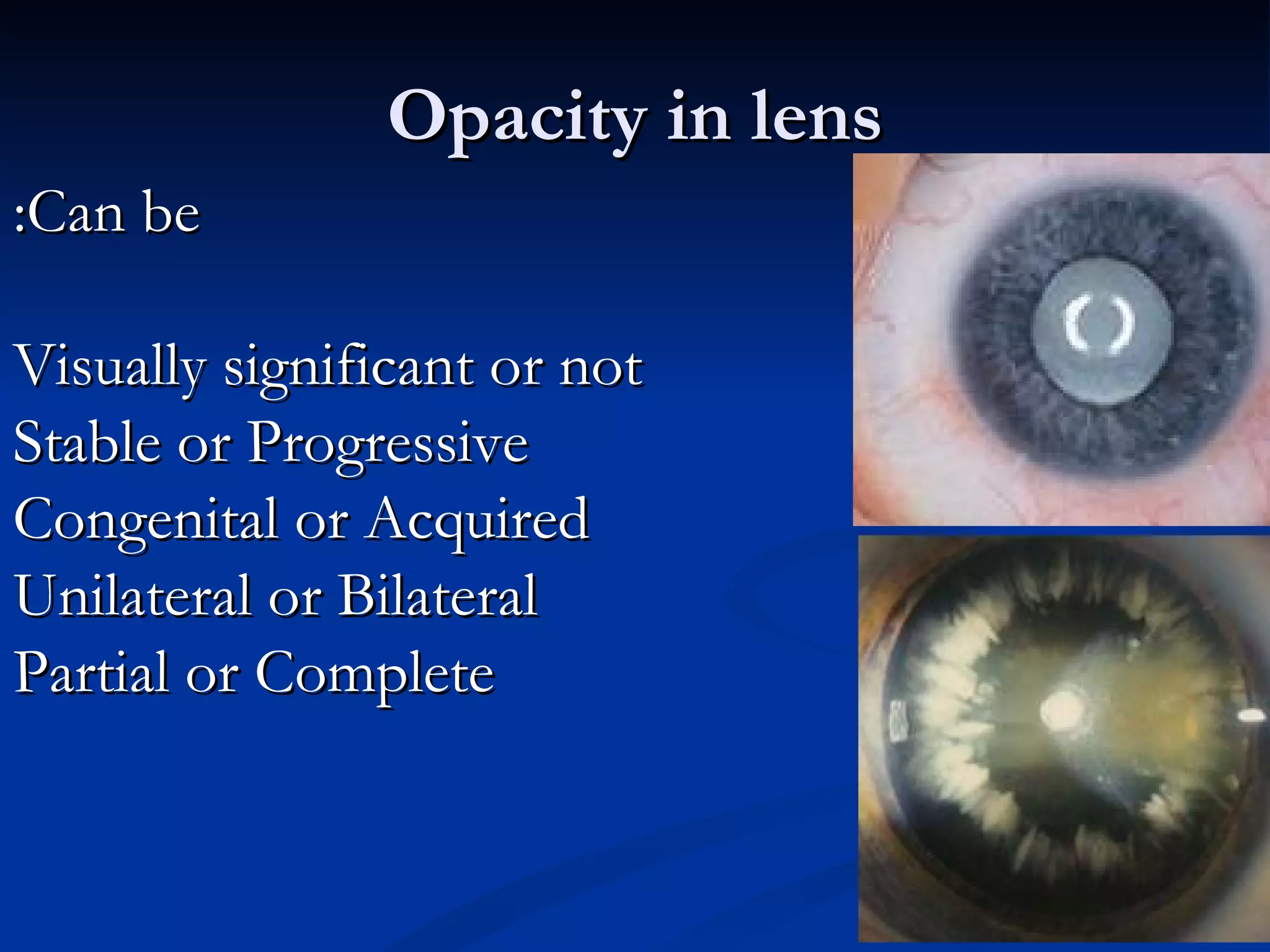 ophthalmology.Diseases of the lens.(dr.baxtyar) | PPT