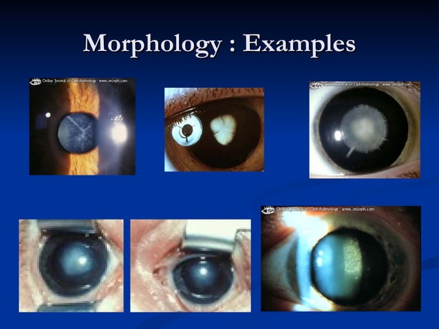 ophthalmology.Diseases of the lens.(dr.baxtyar) | PPT