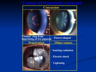 ophthalmology.Diseases of the lens.(dr.baxtyar) | PPT