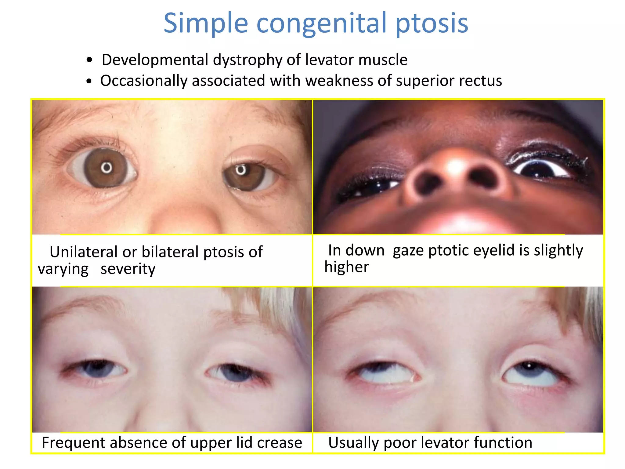 DISEASES OF THE LIDS---pptx | PPTX