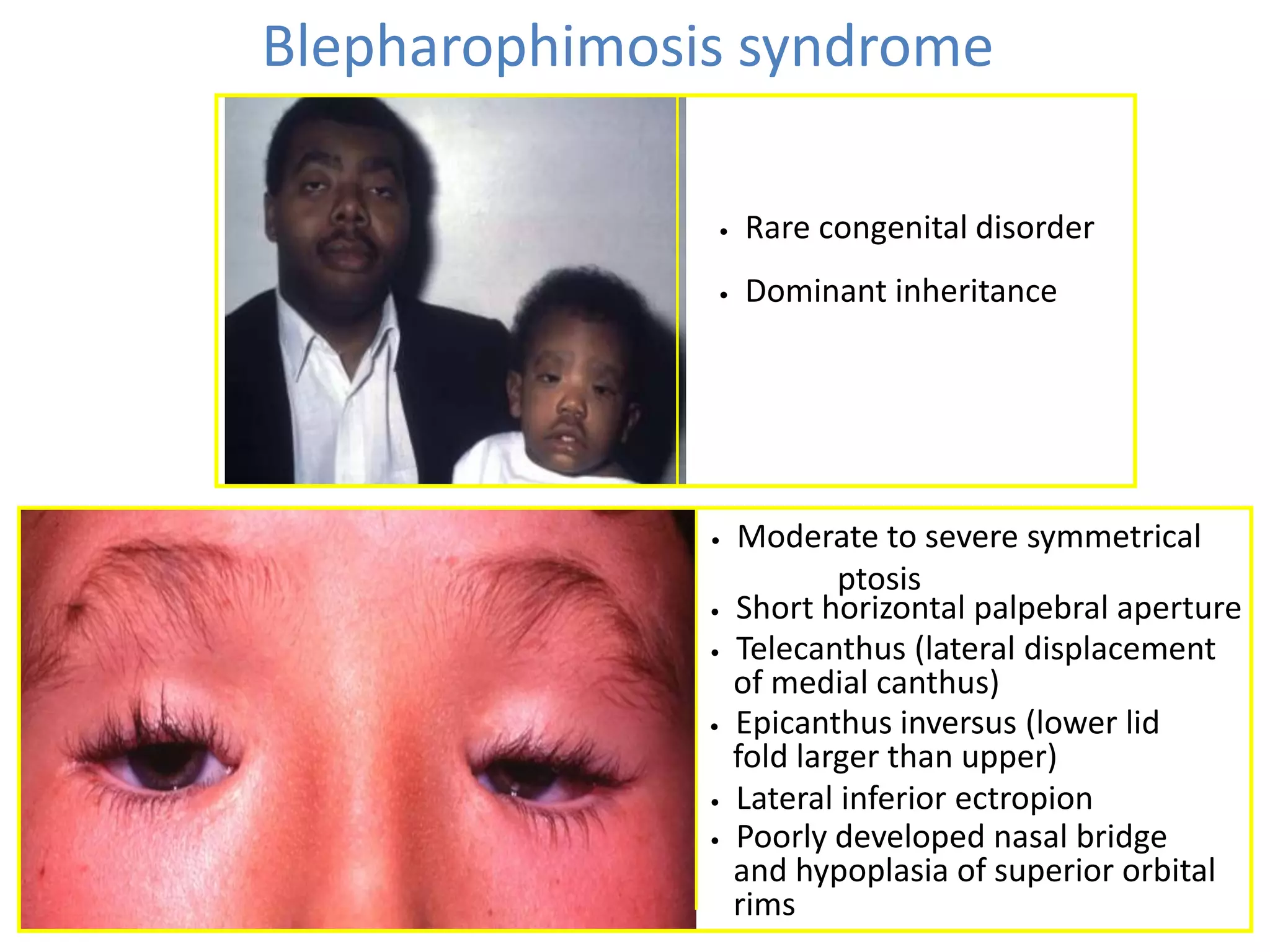 DISEASES OF THE LIDS---pptx | PPTX