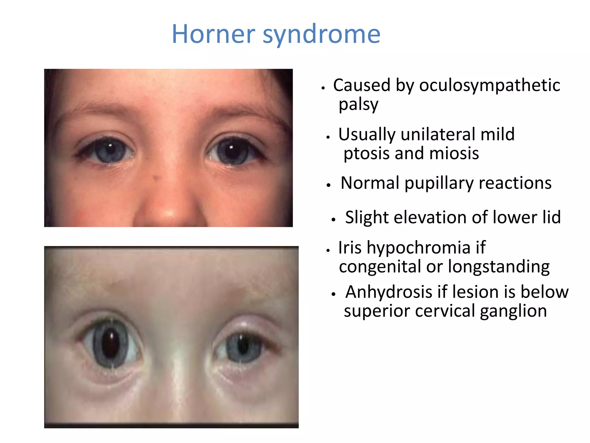 DISEASES OF THE LIDS---pptx | PPTX