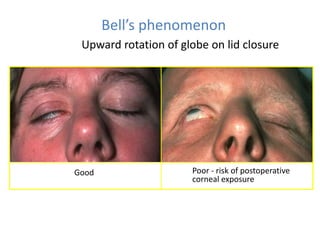 DISEASES OF THE LIDS---pptx | PPTX