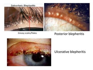 DISEASES OF THE LIDS---pptx | PPTX