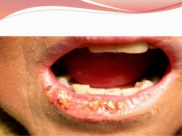Diseases of the lips and tongue