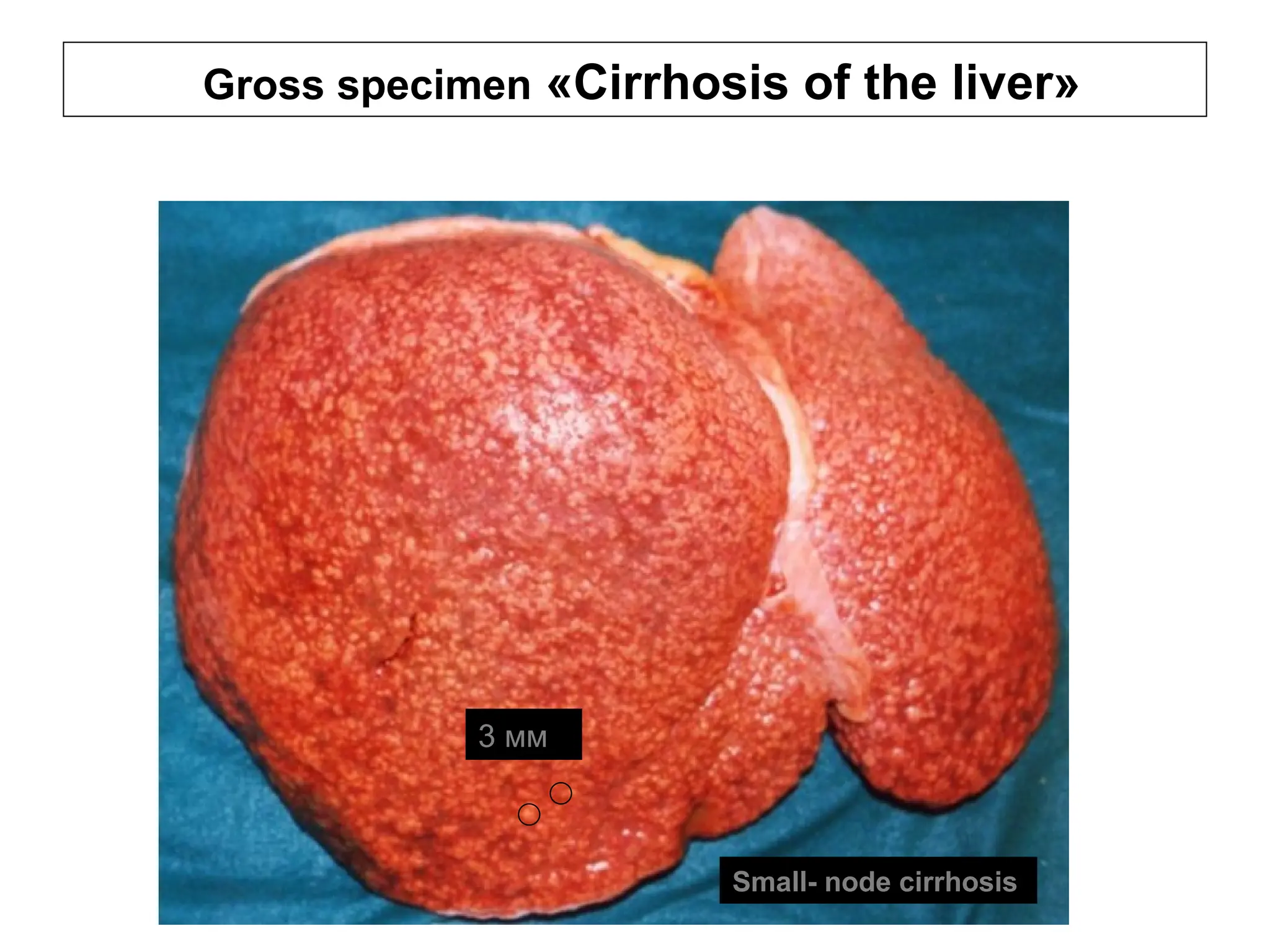 Diseases of the liver - pancreas- and gallbladder -1-.ppt