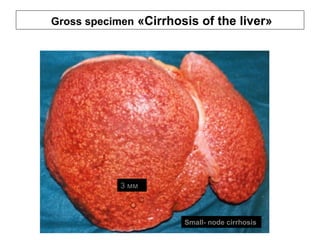Diseases of the liver - pancreas- and gallbladder -1-.ppt