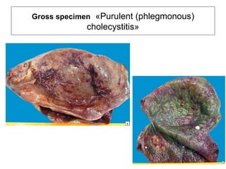 Diseases of the liver - pancreas- and gallbladder -1-.ppt