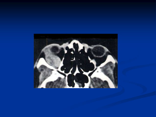 Diseases of the Orbit | PPT | Eye and Vision Conditions | Diseases and ...