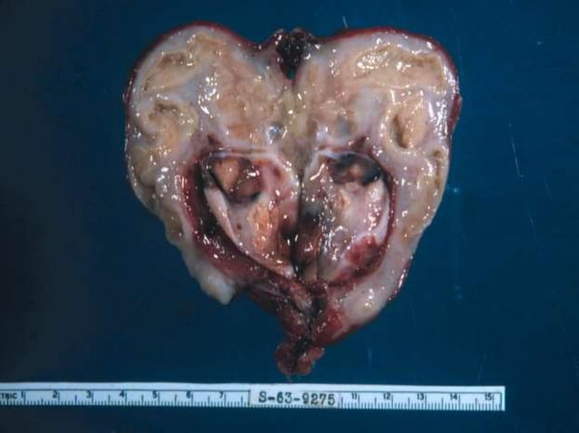 Diseases of the ovaries | PPTX