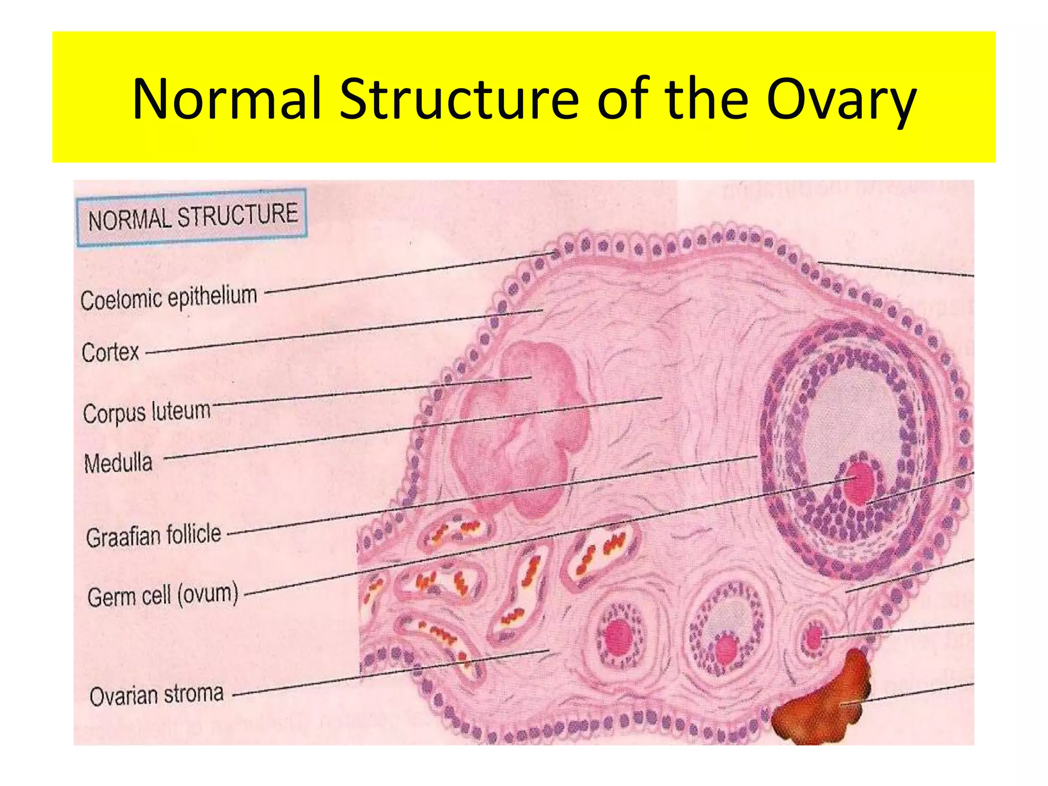 Diseases of the ovary | PPTX
