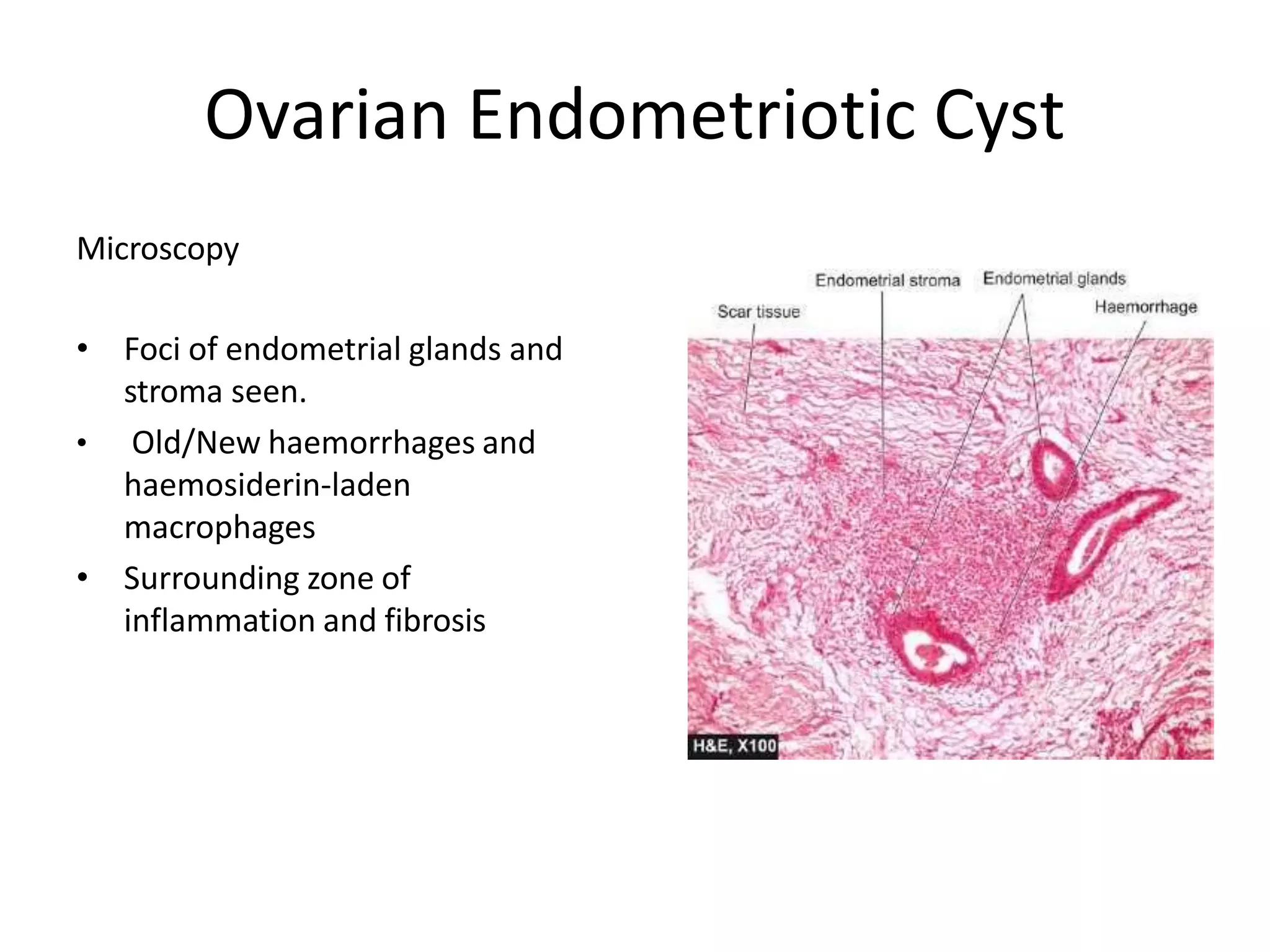diseases of the ovary.pptx