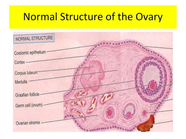 diseases of the ovary.pptx | Free Download