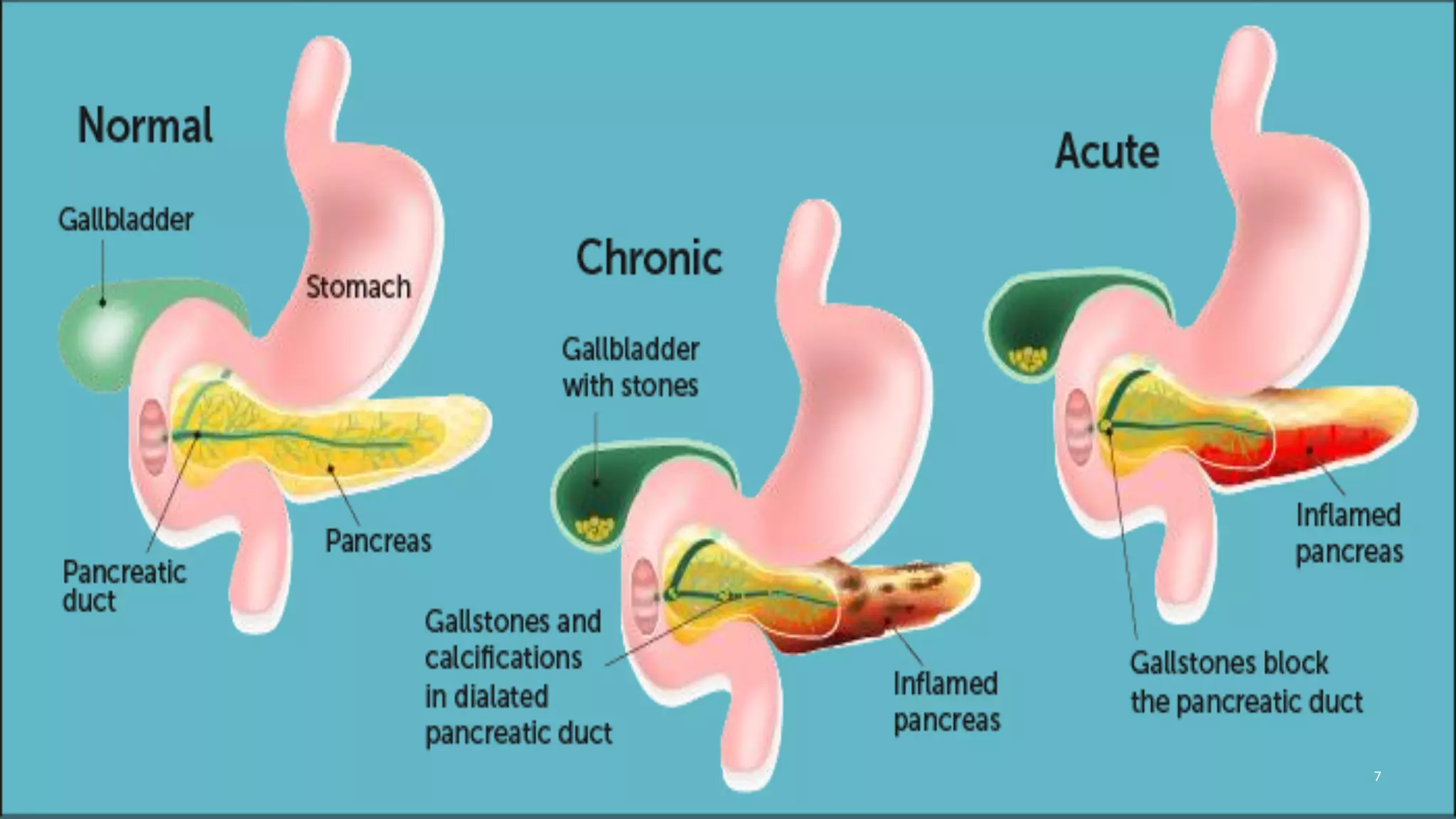 Diseases of the pancreas | PDF