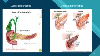 Diseases of the pancreas | PDF