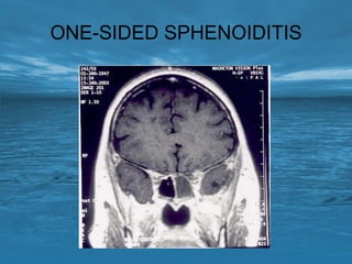 Diseases of the paranasal sinuses. | PPT