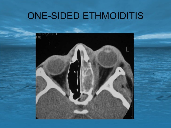 Diseases of the paranasal sinuses.