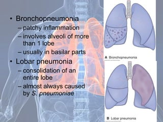 Diseases of the respiratory system | PPT