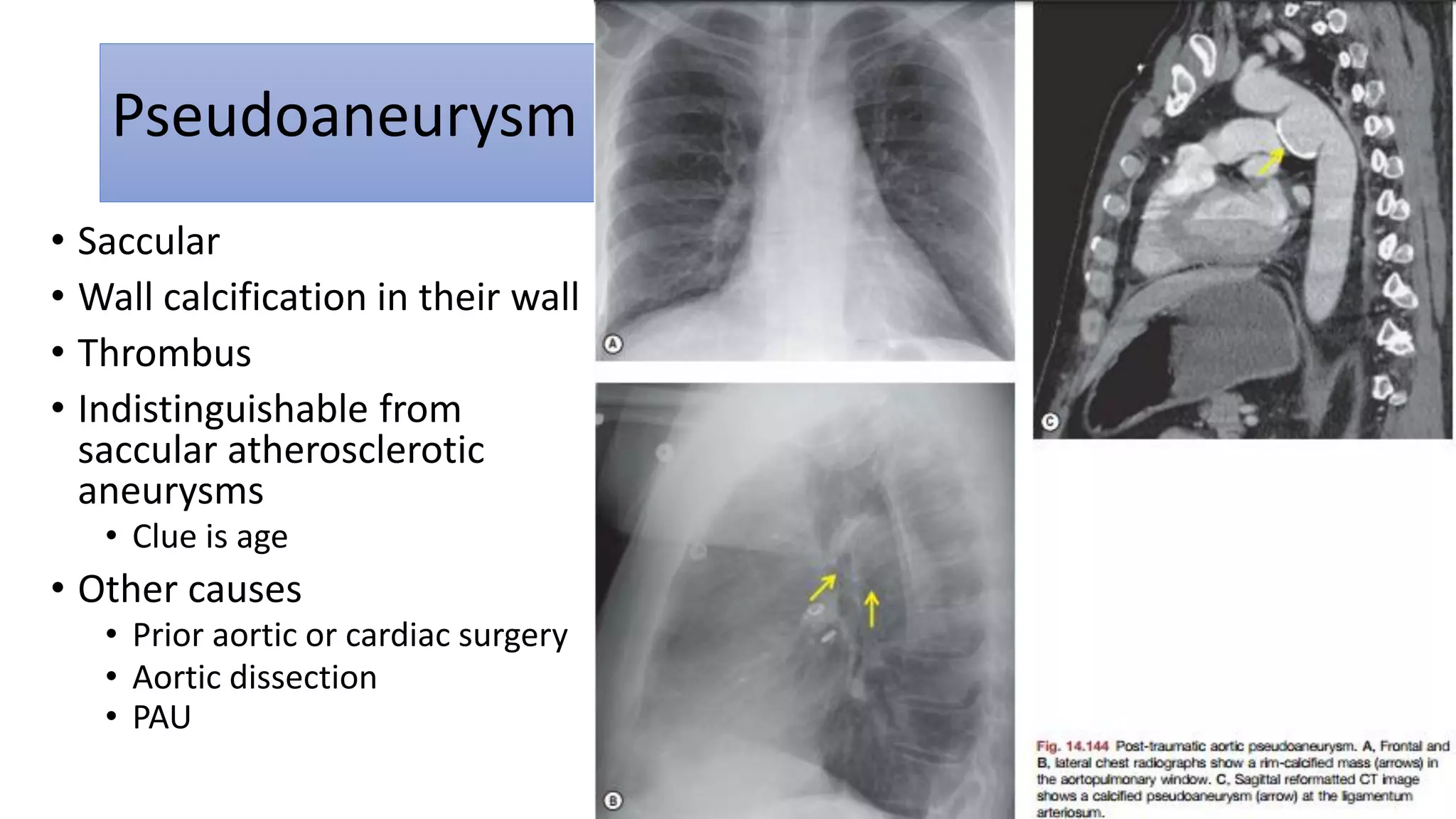 Diseases of the thoracic aorta | PDF