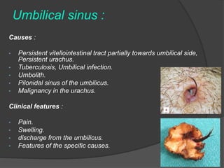 DISEASES OF THE UMBILICUS.pptx