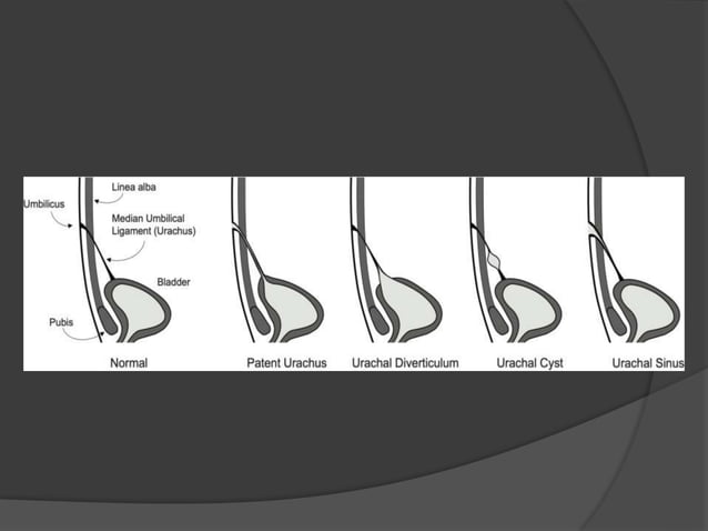 DISEASES OF THE UMBILICUS.pptx
